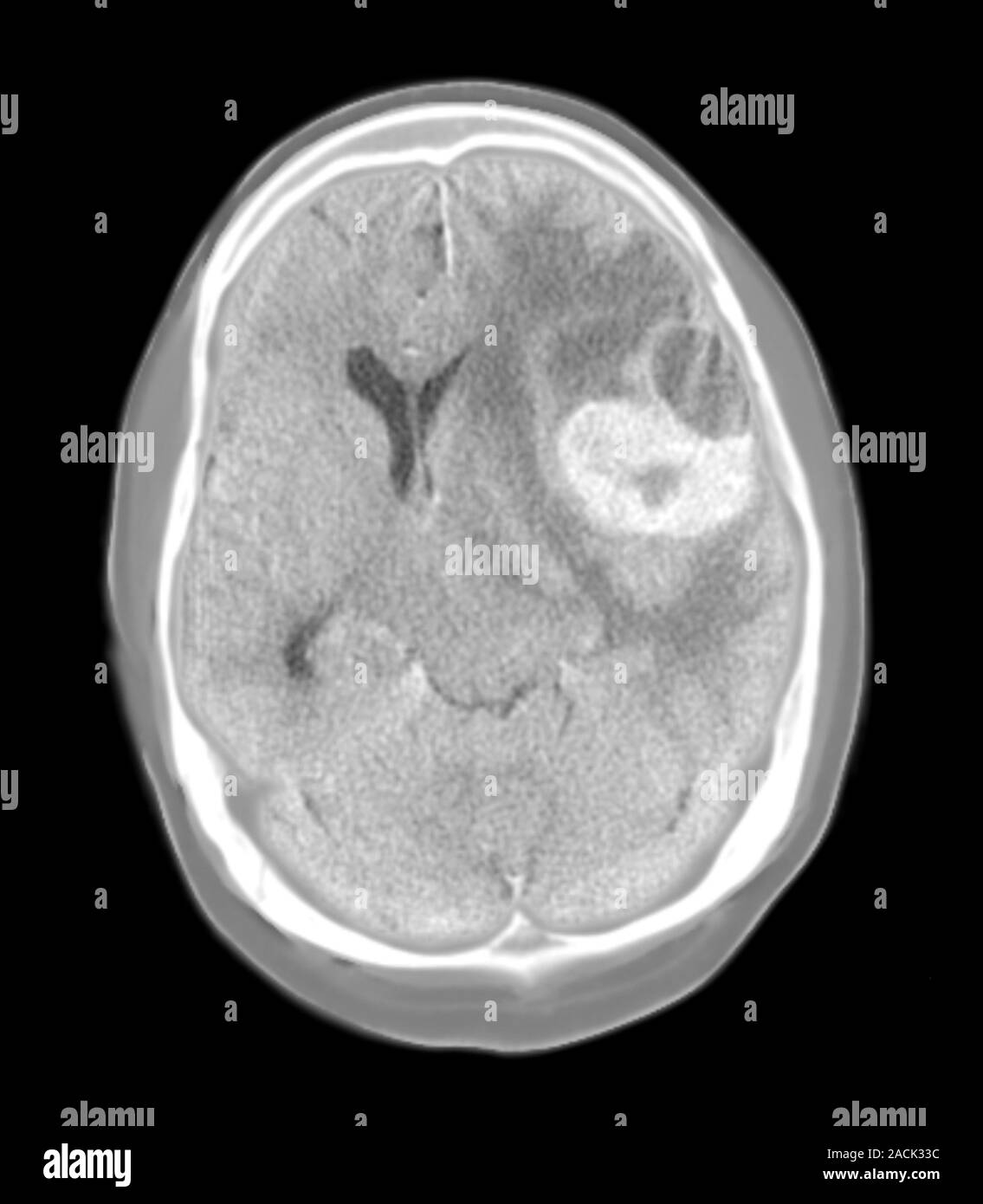 Brain cancer. Axial computed tomography (CT) scan through the head of a ...