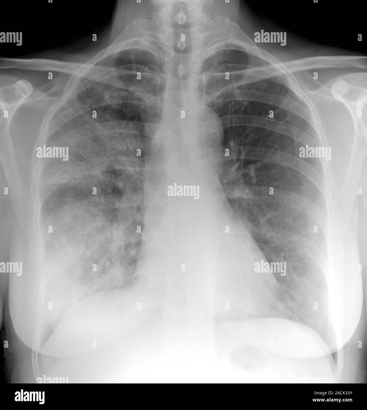 Pneumonia. X-ray of the chest of a 49 year old female patient with ...