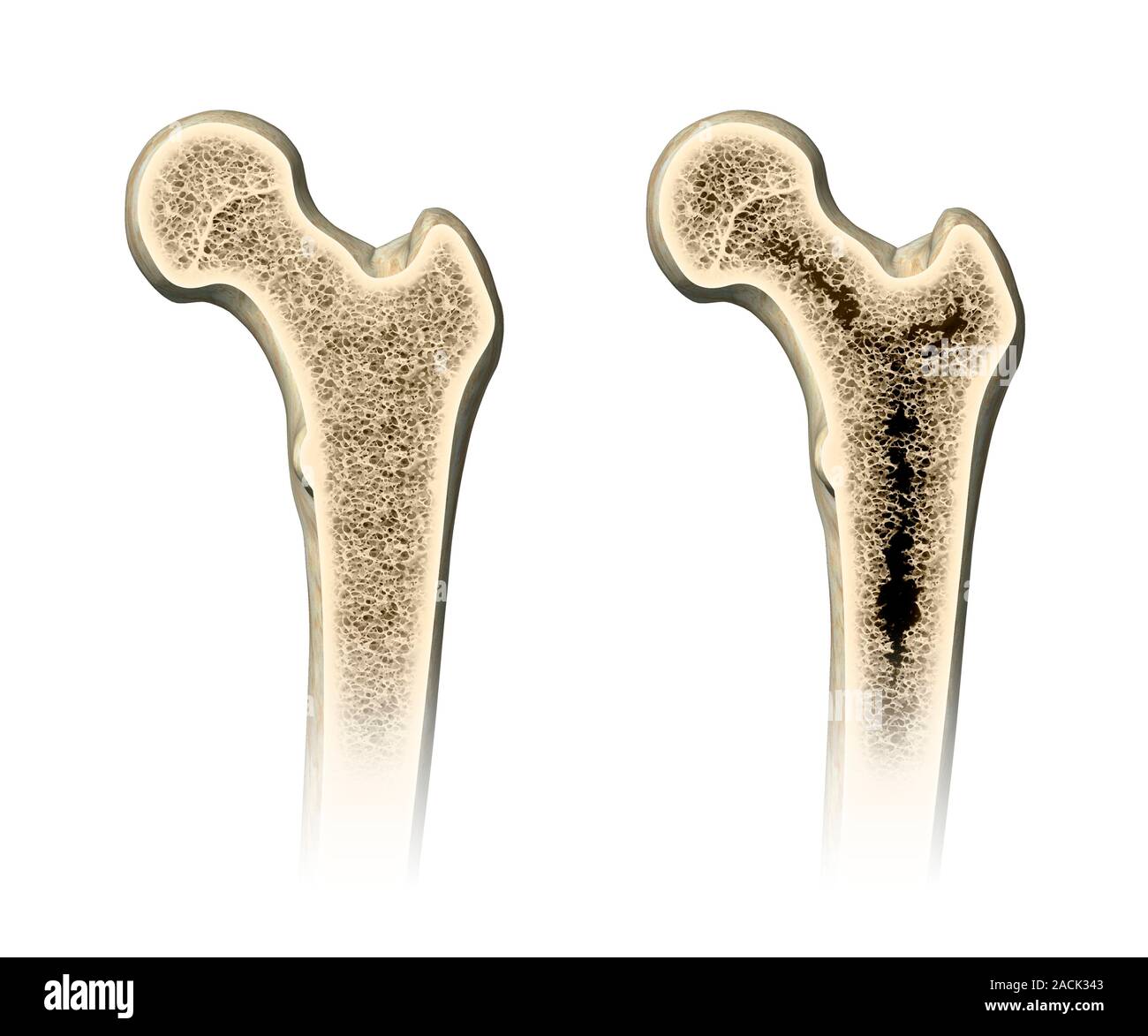 Osteoporosis. Artwork of vertical sections comparing the upper parts of ...