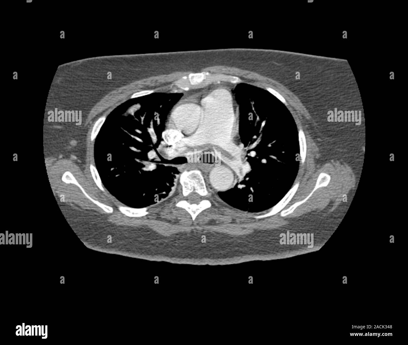 Pulmonary embolism. Computer tomography (CT) scan of a section through ...