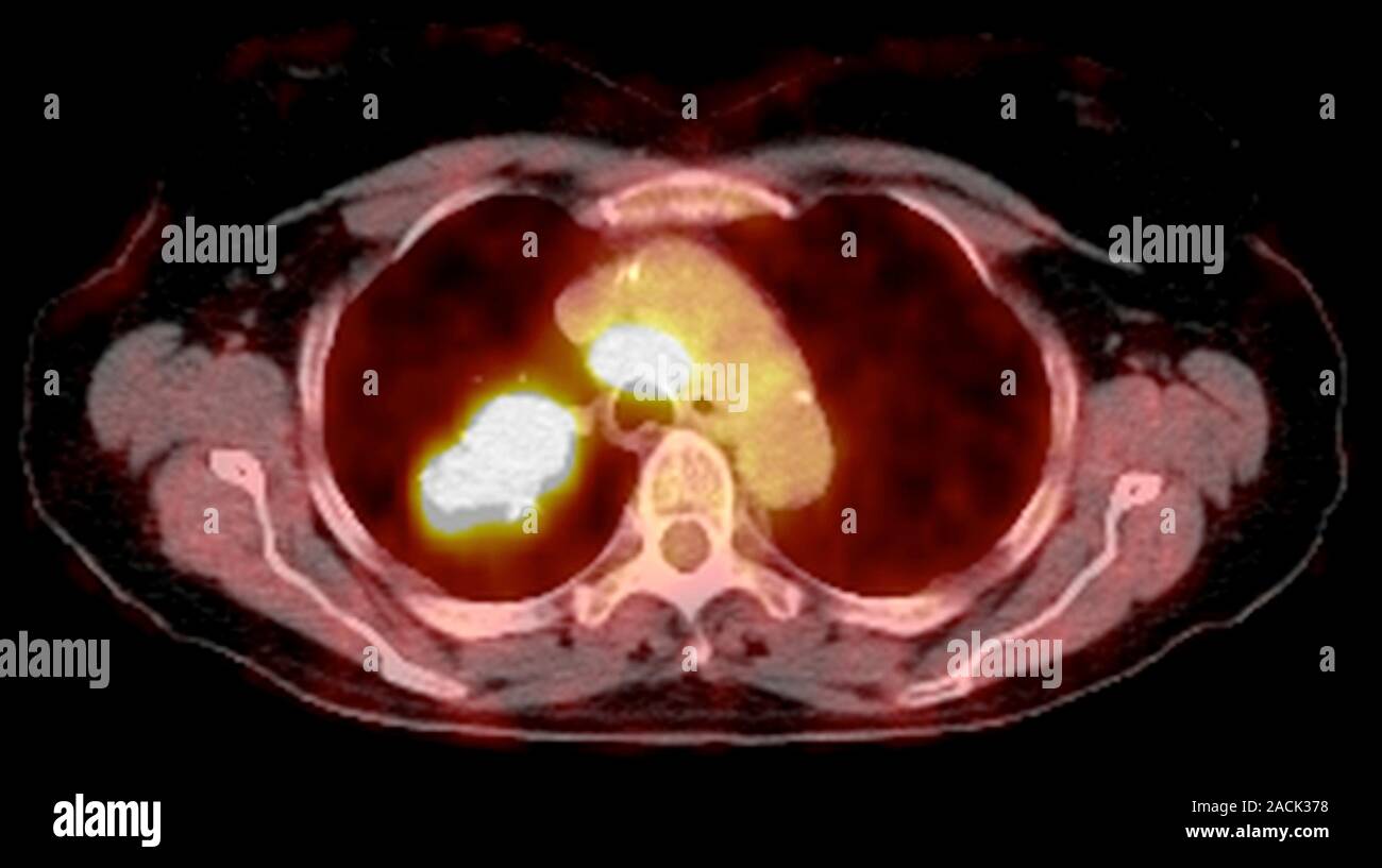 Lung cancer. Coloured combined computed tomography (CT) and positron ... Lung cancer. Coloured combined computed tomography (CT) and positron ...