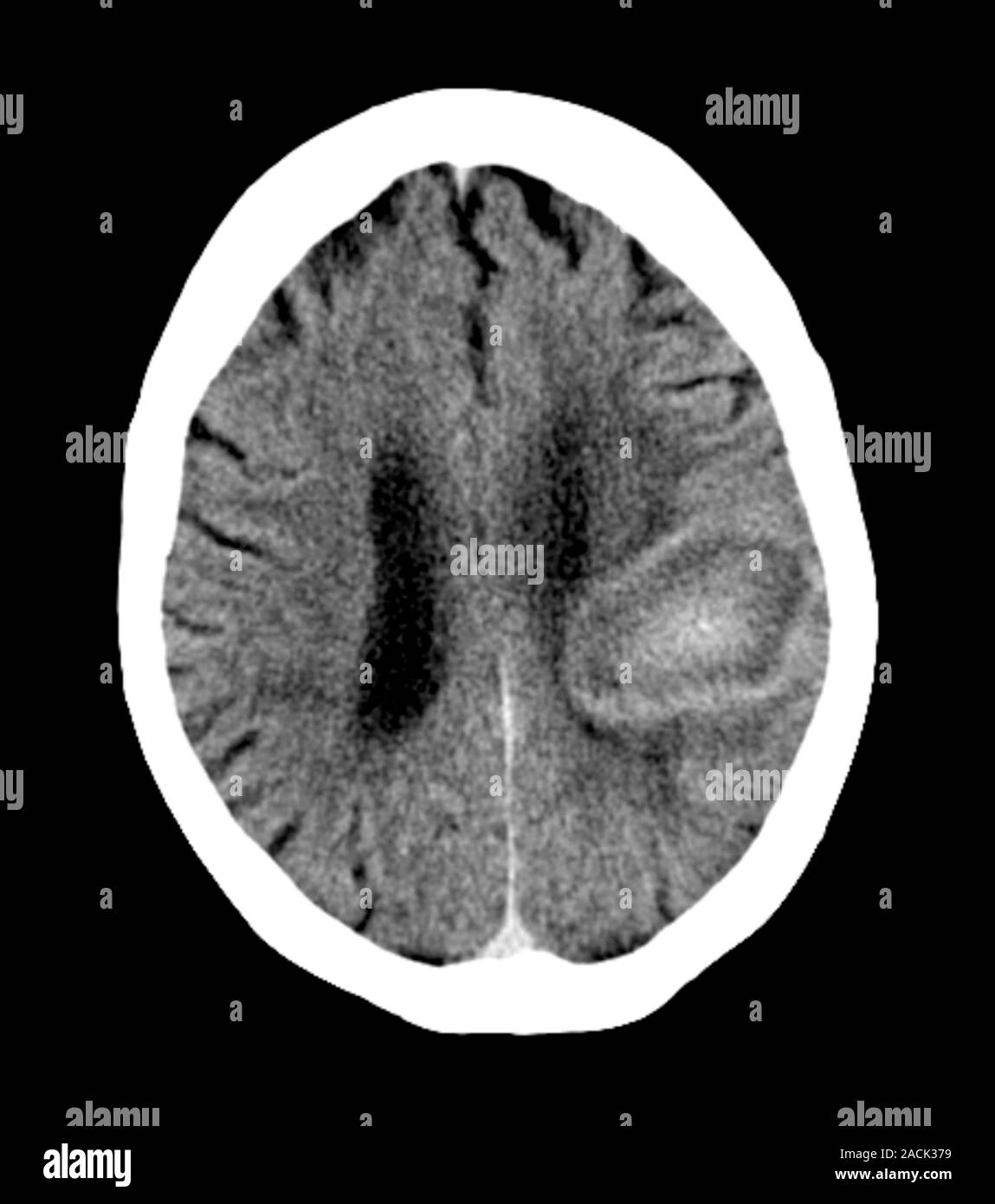 Haematoma. Computed tomography (CT) scan of the brain of a 80 year old ...