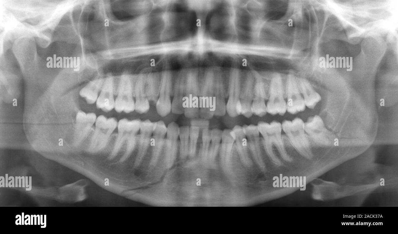 Fractured Cheekbone X Ray