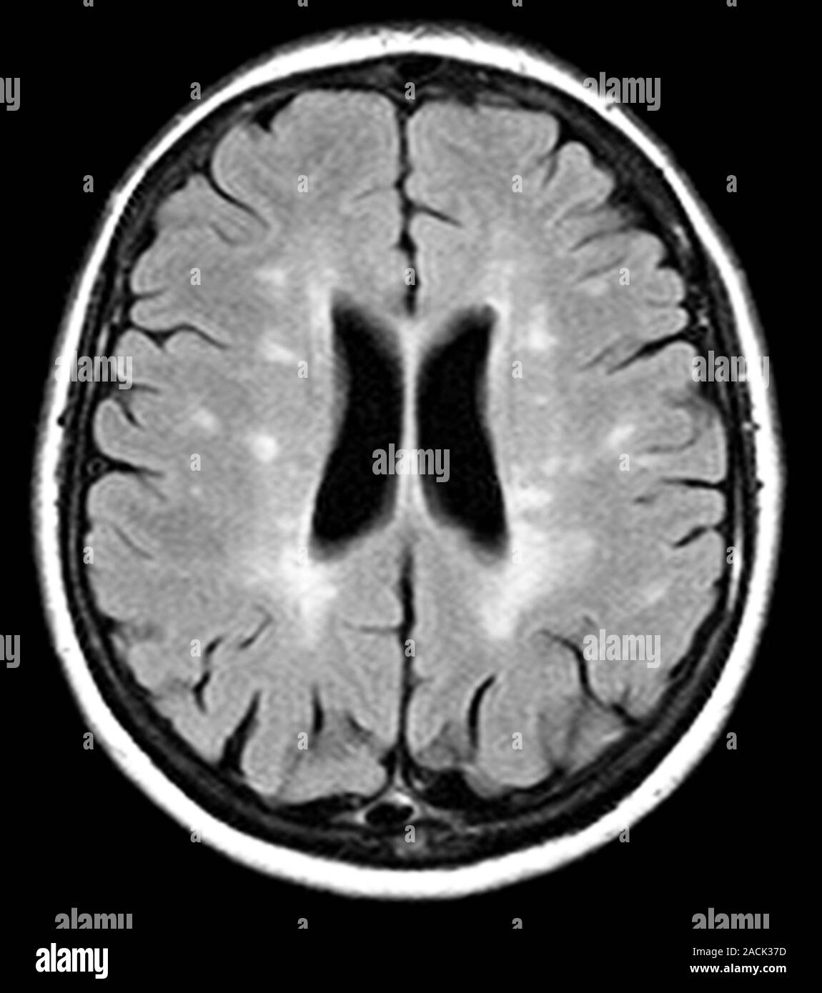 Multiple sclerosis. Fluid attenuated inversion recovery (FLAIR) magnetic resonance imaging (MRI ...