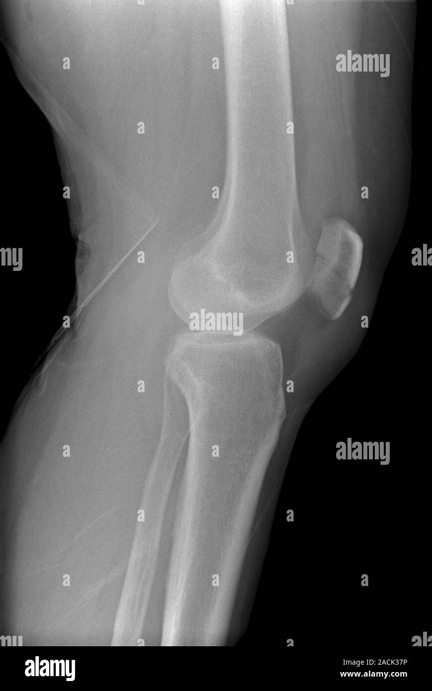Broken knee. X-ray of the knee of a 54 year old female with a fractured ...