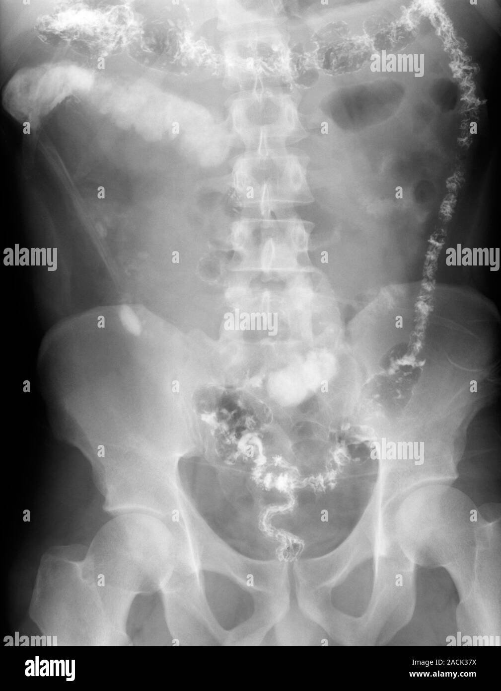 Ulcerative colitis. X-ray of the abdomen of a 30-year-old man with ...
