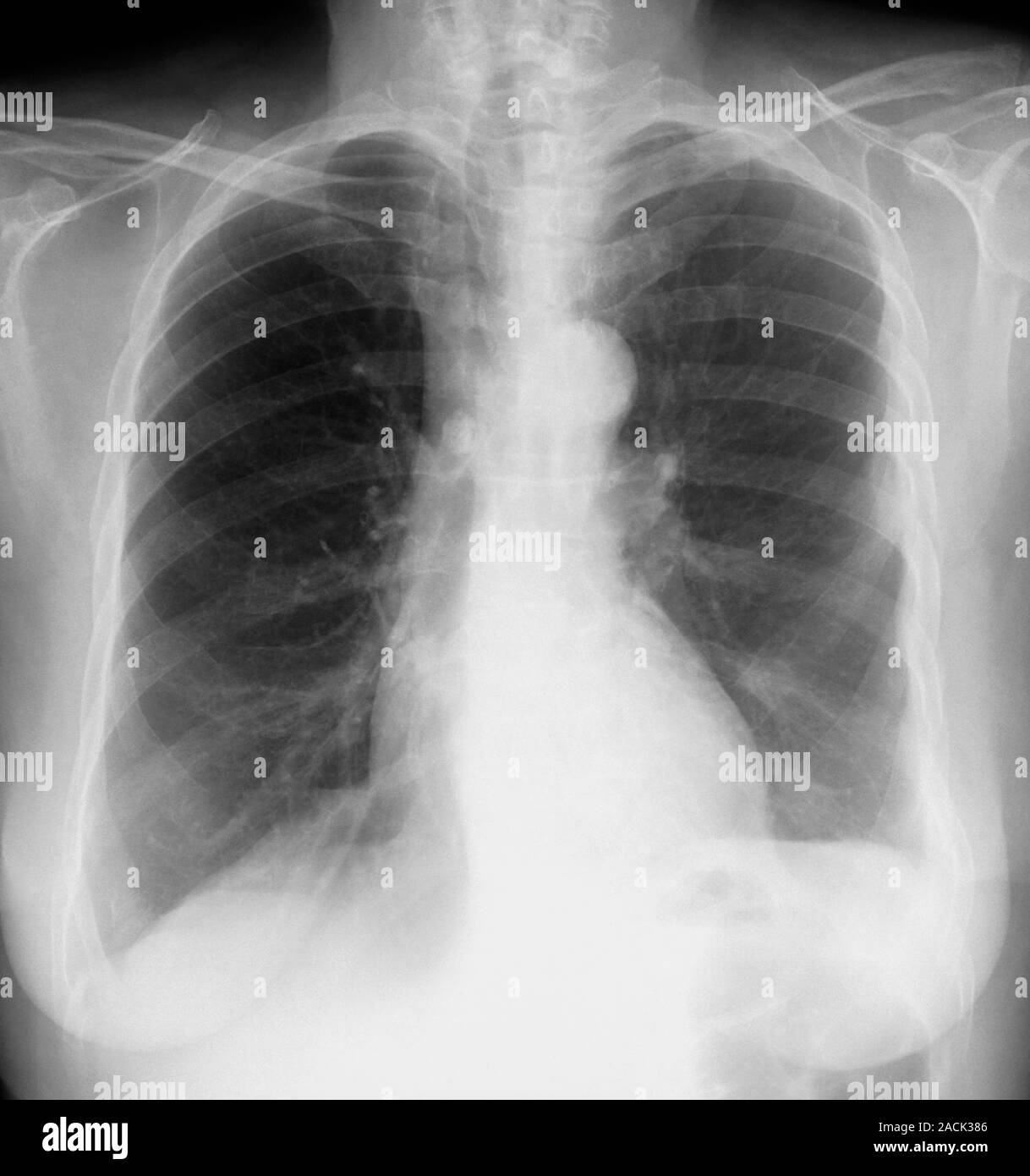 Aortic aneurysm. X-ray of the chest of a 68-year-old woman with an ...