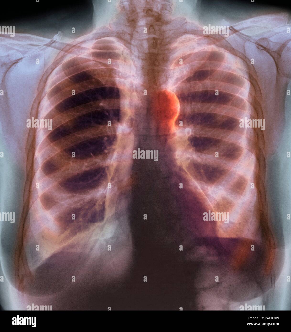 Aortic aneurysm. Coloured X-ray of the chest of a 68-year-old woman ...