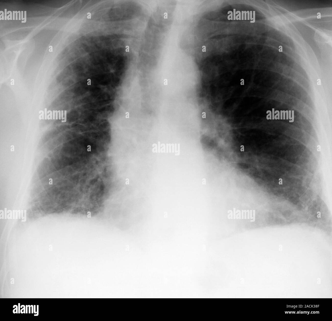 Fibrosing alveolitis. X-ray of the chest of an 82-year-old man with ...