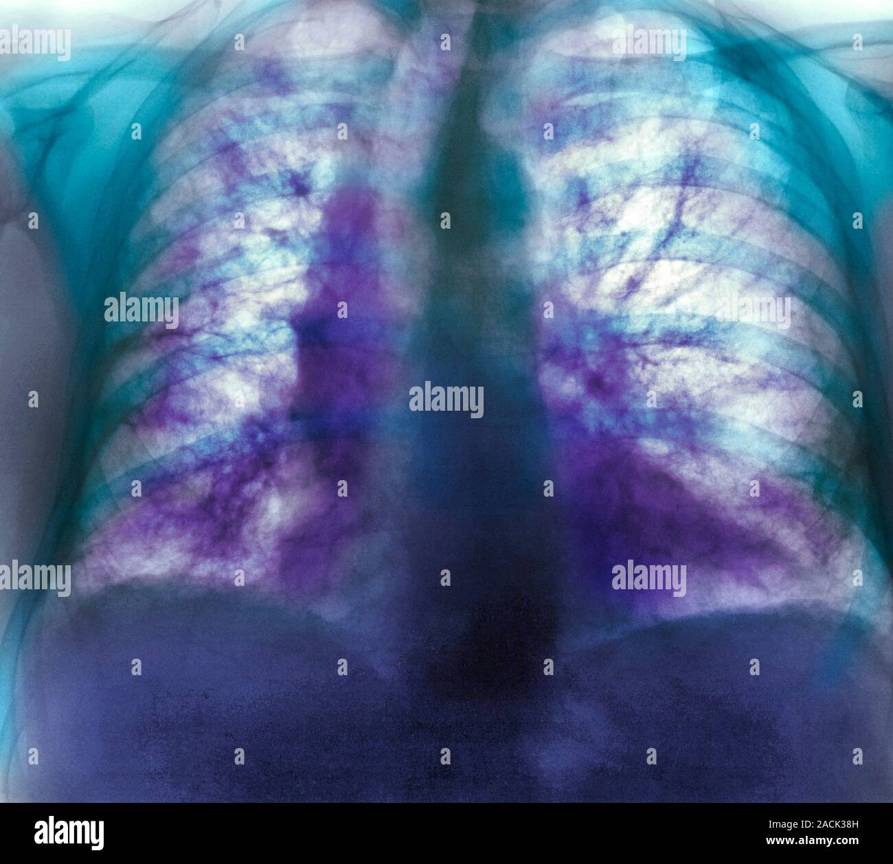 Fibrosing alveolitis. Coloured X-ray of the chest of an 82-year-old man ...