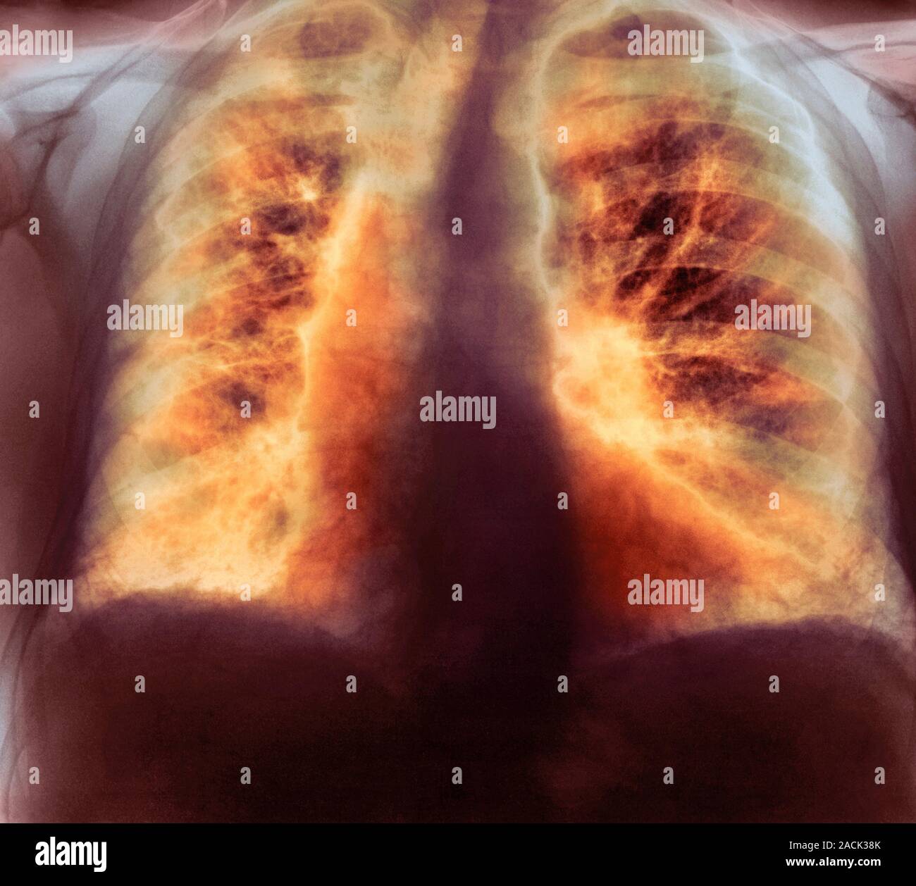 Fibrosing alveolitis. Coloured X-ray of the chest of an 82-year-old man ...
