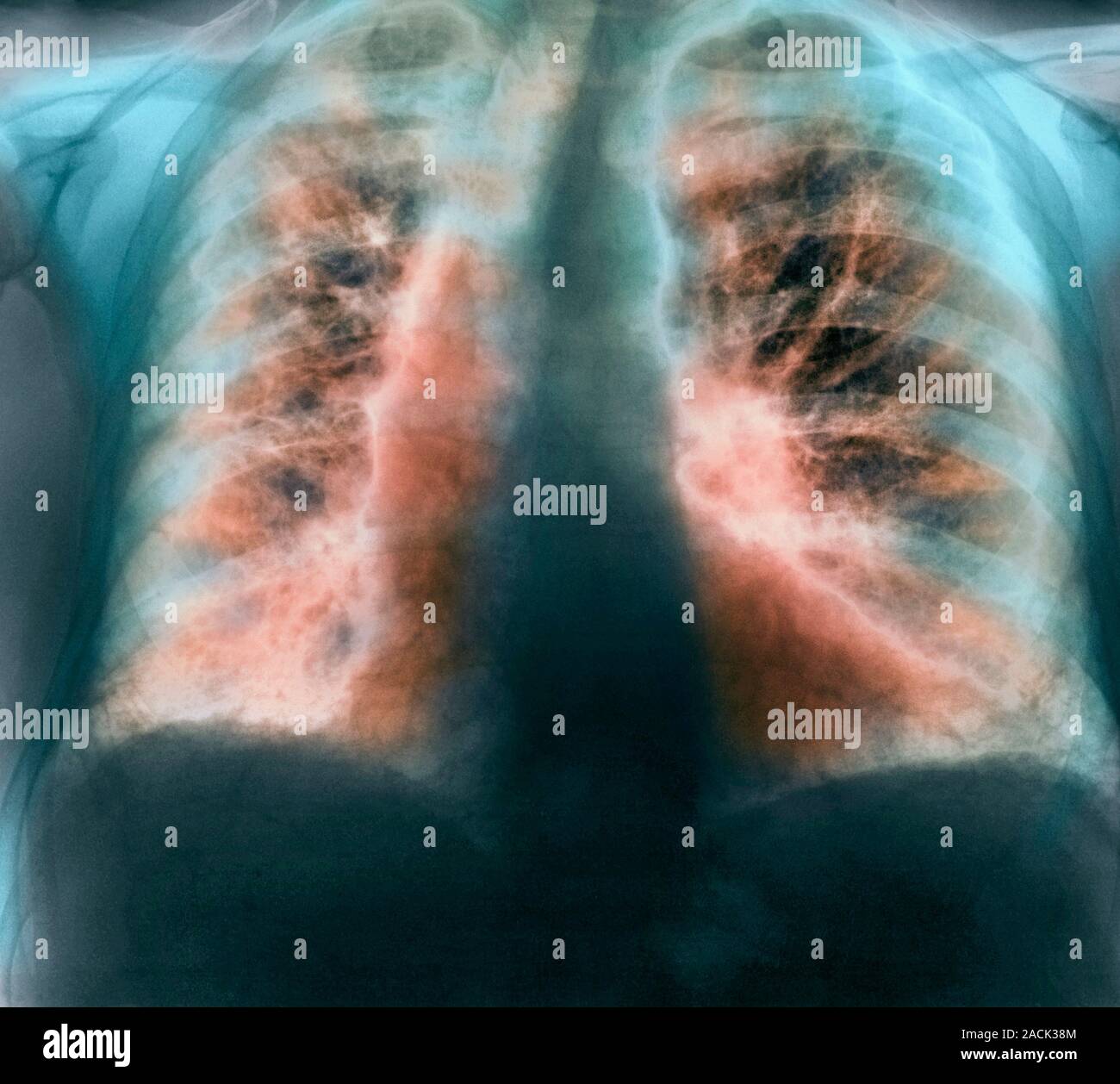 Fibrosing alveolitis. Coloured X-ray of the chest of an 82-year-old man ...