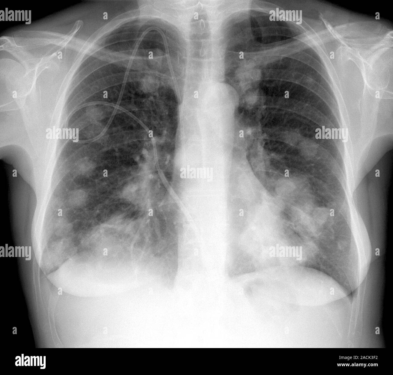 Lung cancer. X-ray of malignant (cancerous) tumours (white areas) in a ...