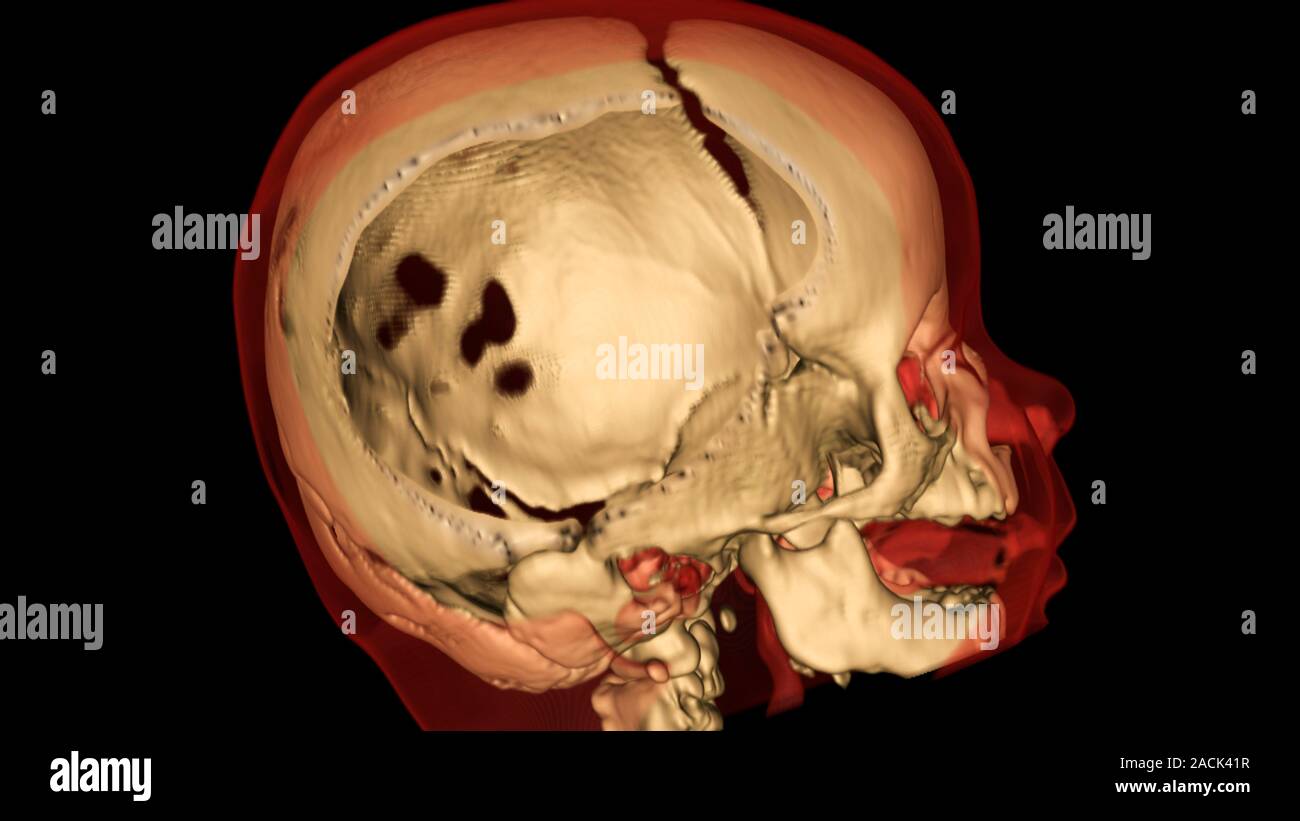 Child's skull. Coloured 3D computed tomography (CT) scan of the skull ...