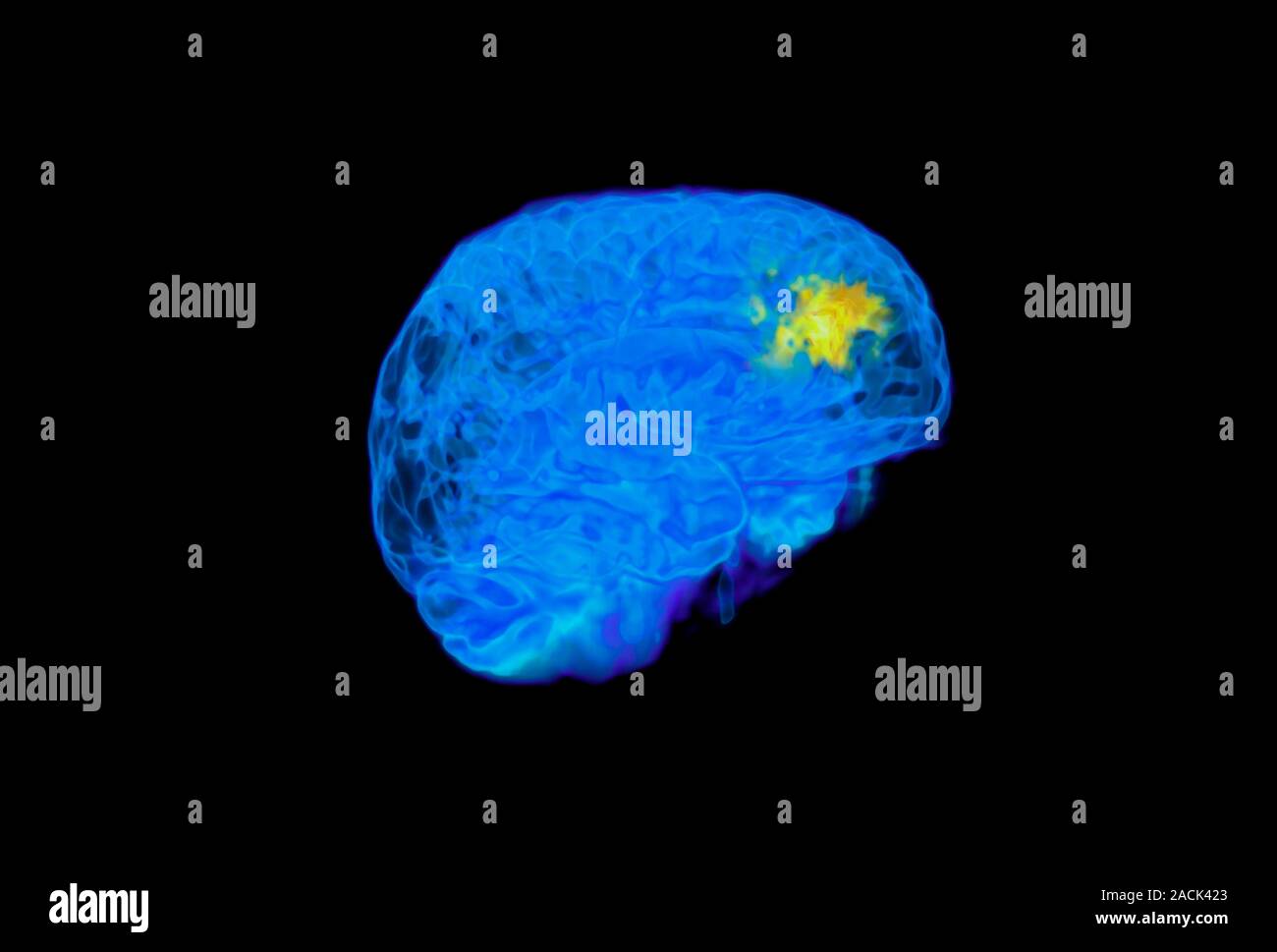 Child's brain activity. Coloured MRI (magnetic resonance imaging) scan ...