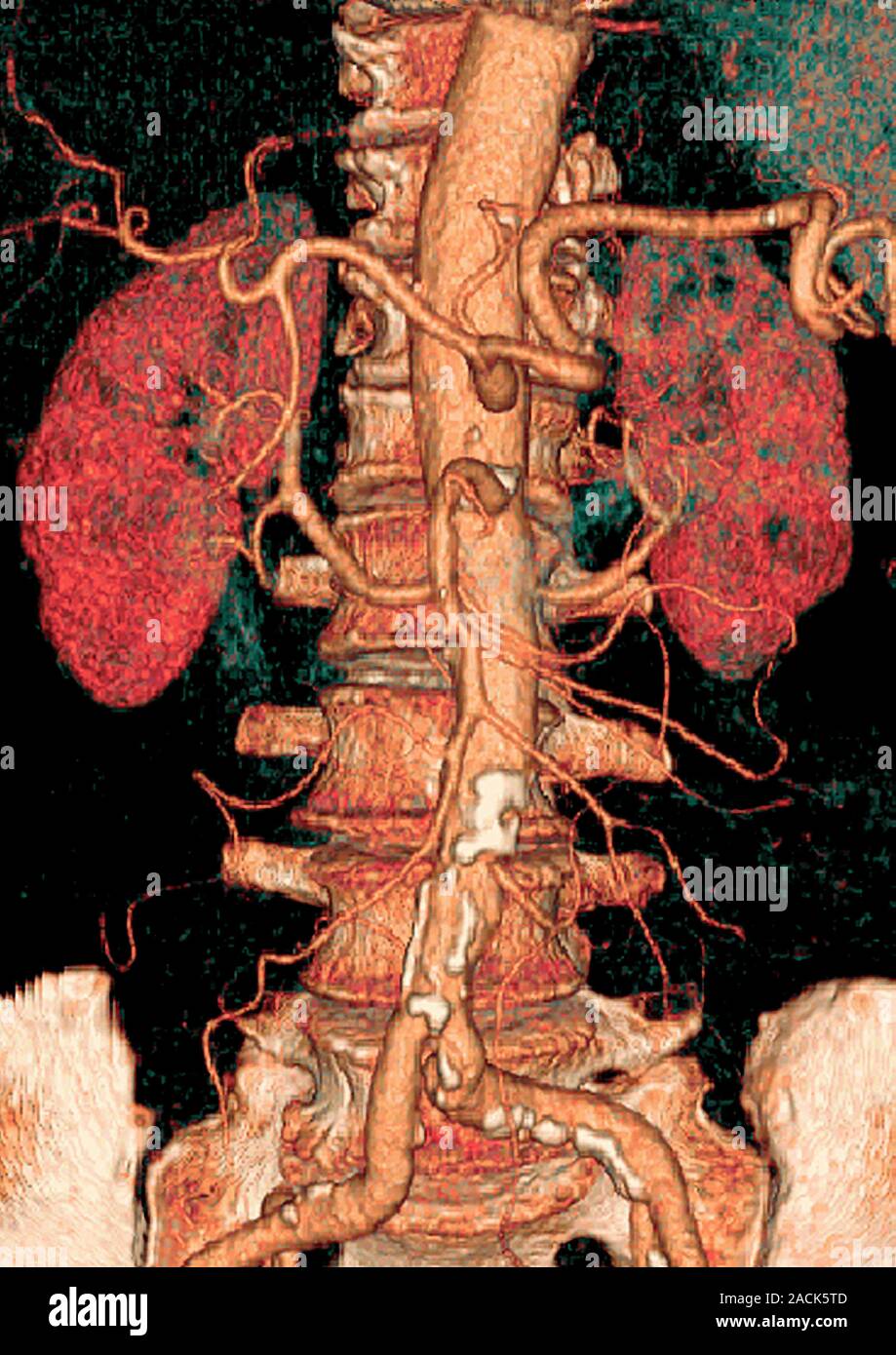 Coloured three-dimensional (3D) Computed Tomography (CT) scan in front view of the abdomen in a ...