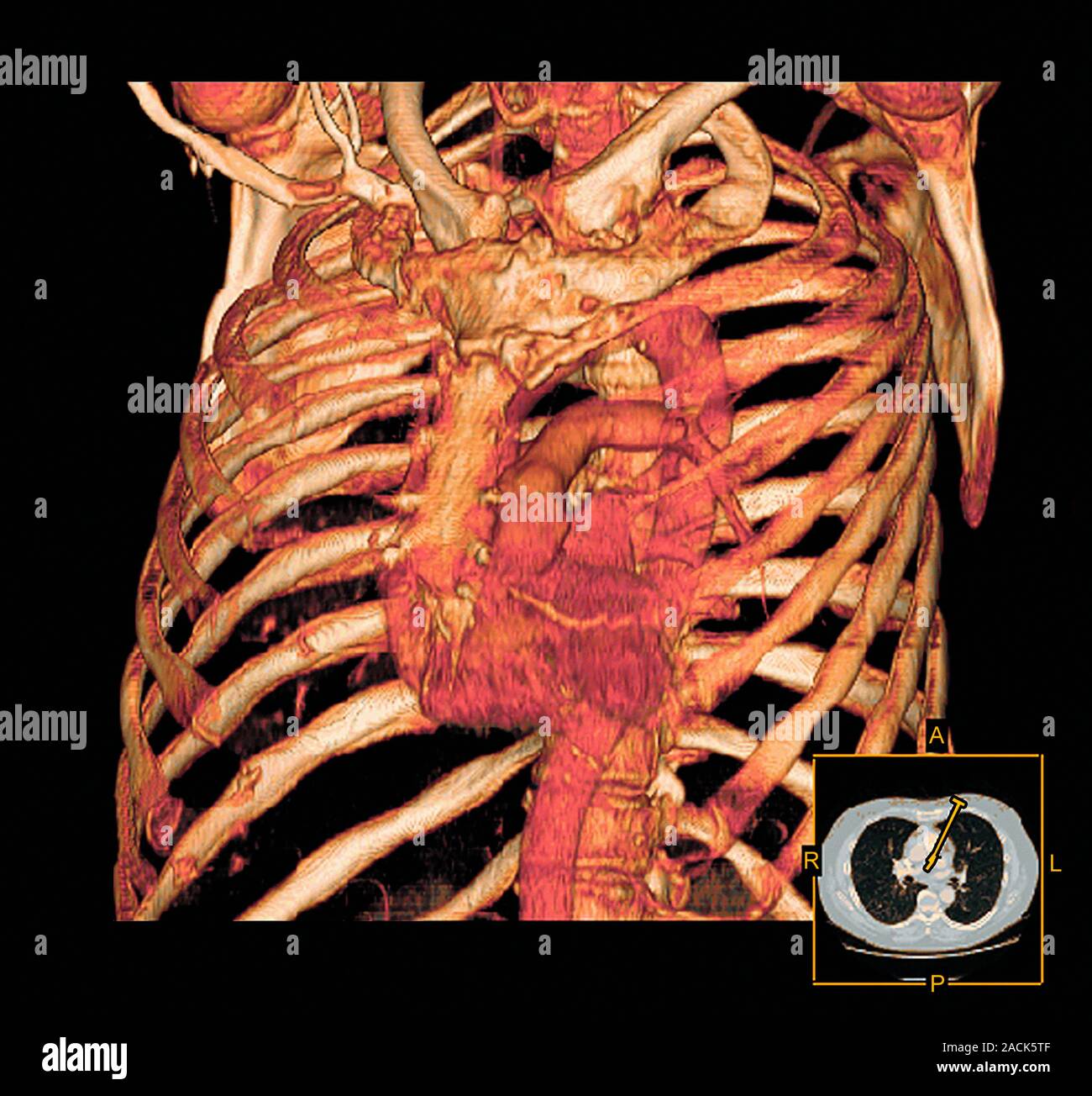 Coloured three-dimensional (3D) Computed Tomography (CT) scan in oblique front view of the chest ...