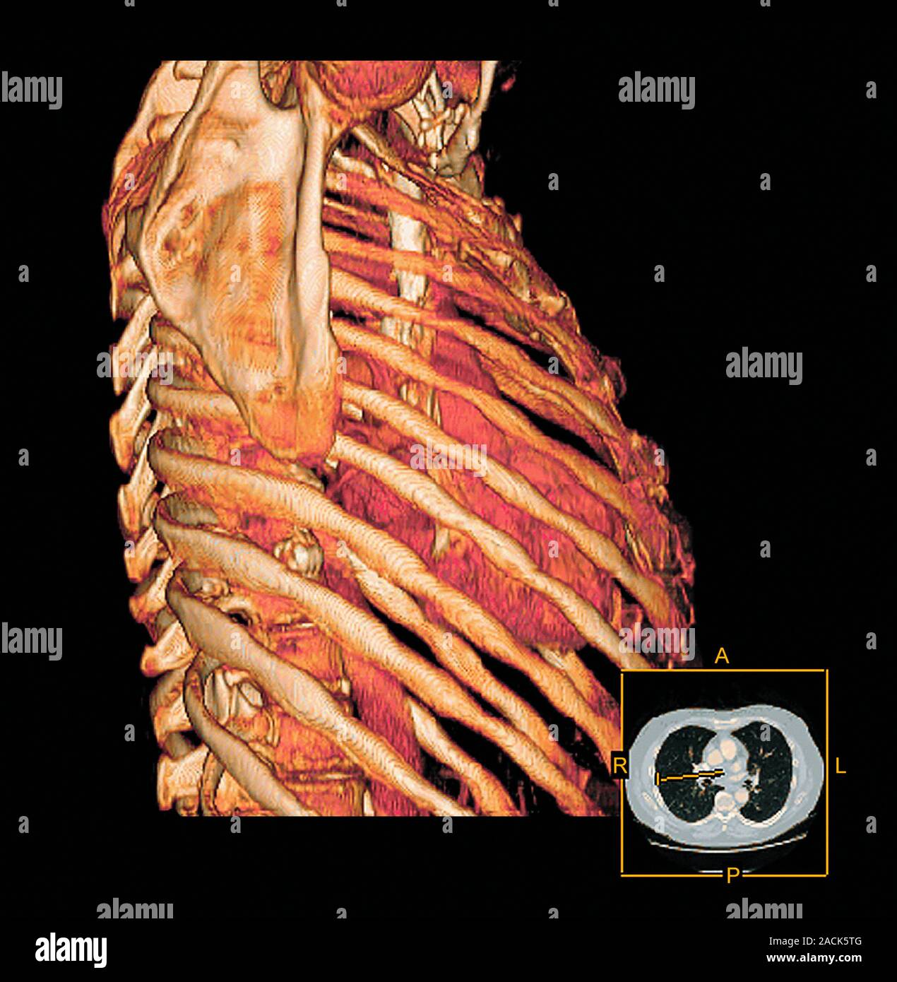 Coloured three-dimensional (3D) Computed Tomography (CT) scan in side view of the chest in a ...