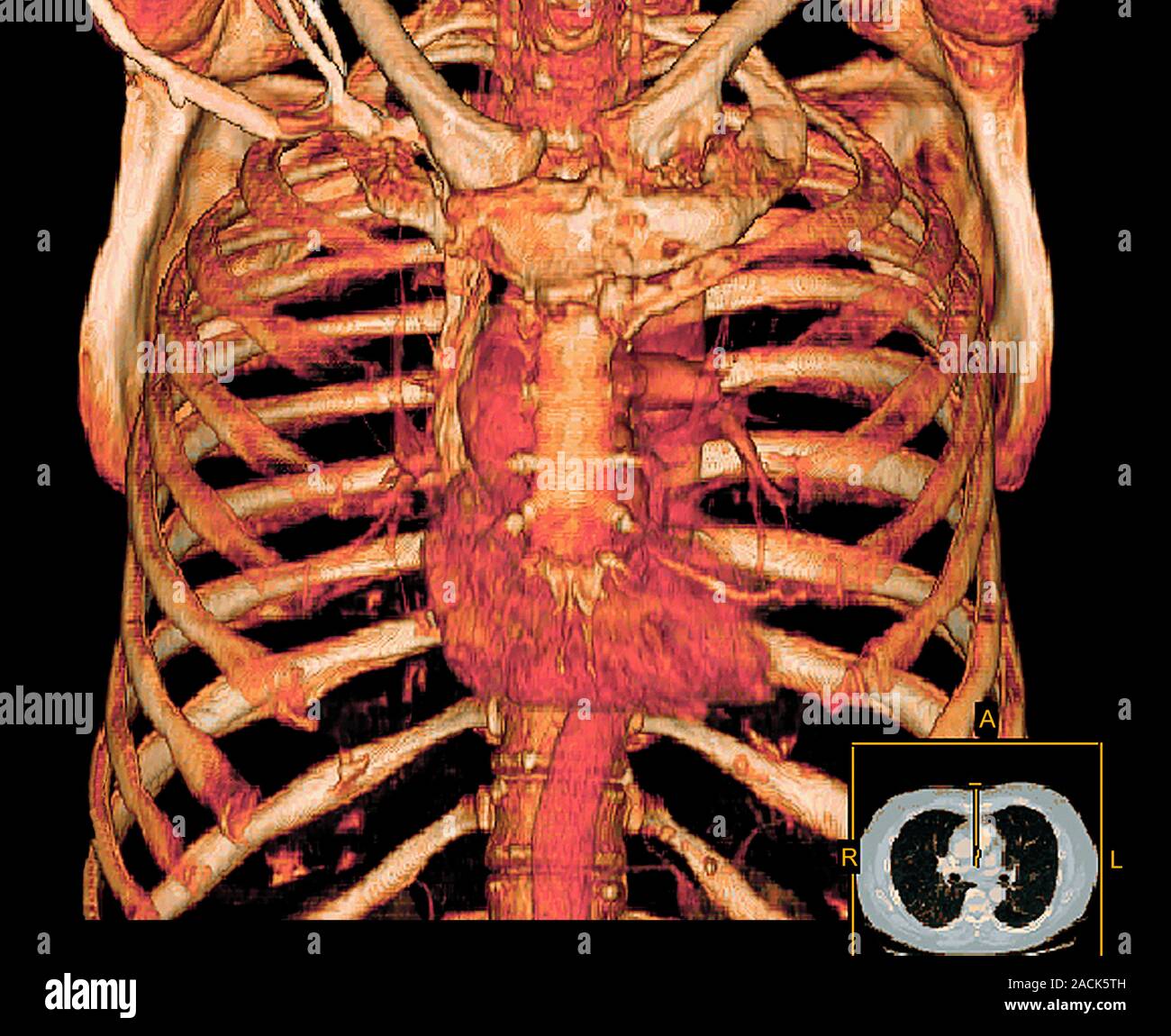 Coloured three-dimensional (3D) Computed Tomography (CT) scan in front view of the chest in a ...