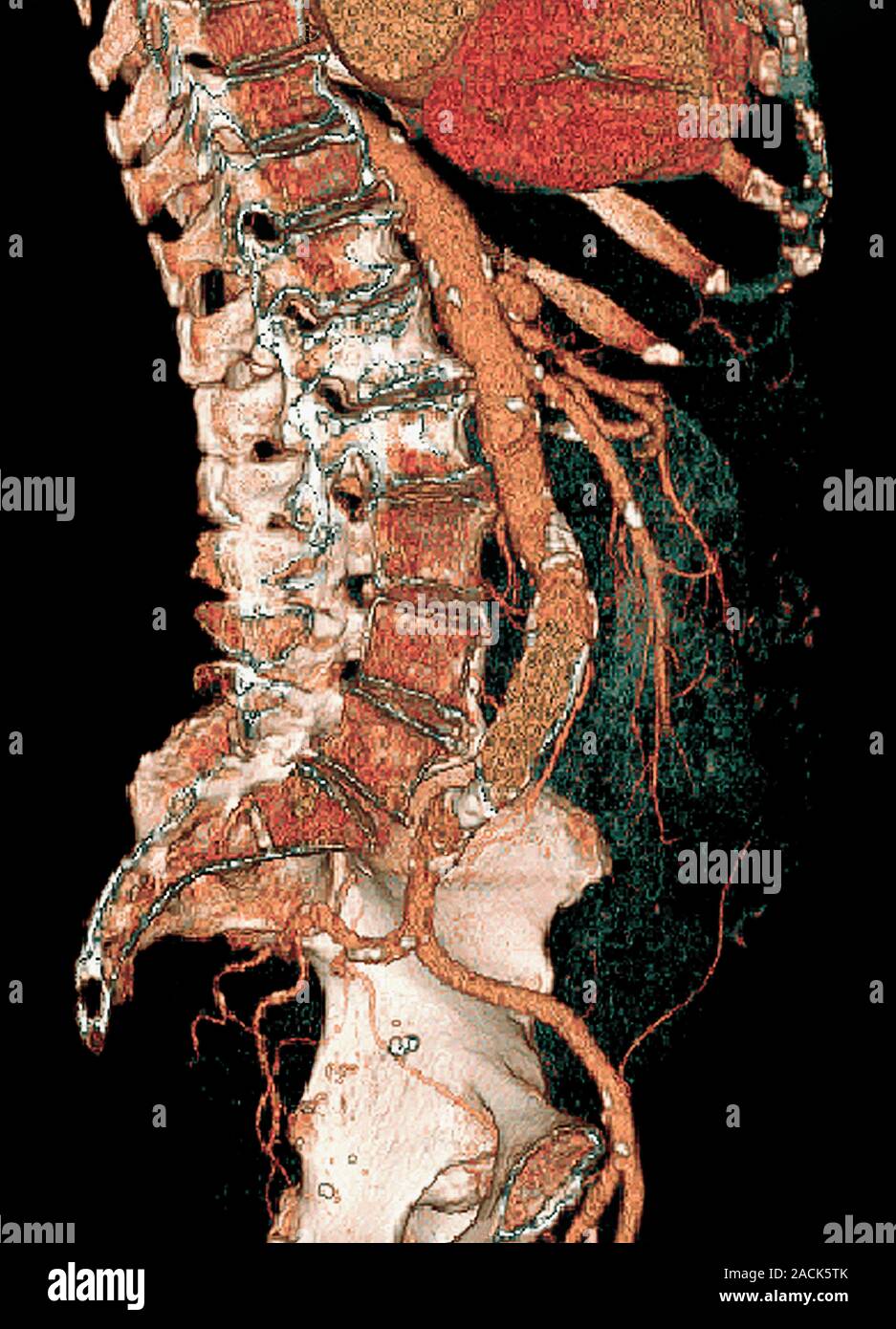 Coloured three-dimensional (3D) Computed Tomography (CT) scan in side view of the vertebral ...