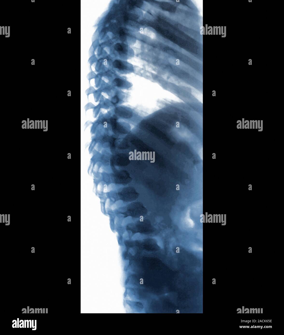 Spine in Hurler Syndrome. Coloured X-ray of the spine of a 26-month-old ...