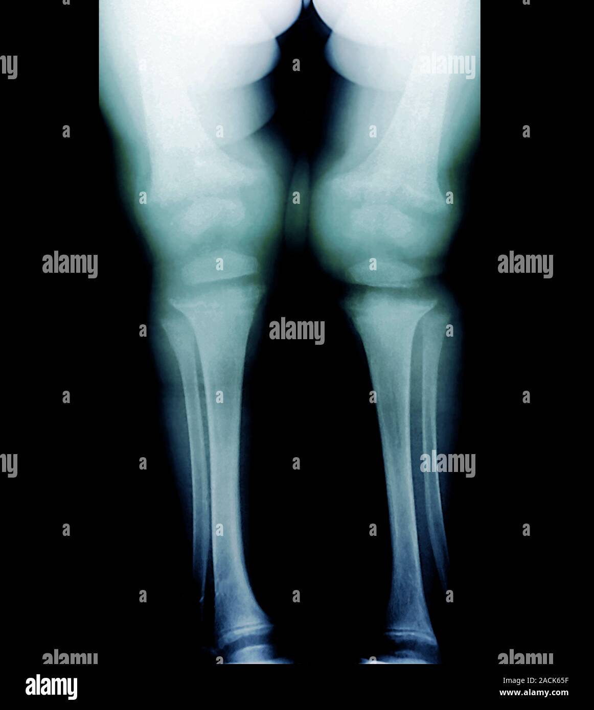 Rickets X Ray Shedding Light On Vitamin D Status And Its Complexities