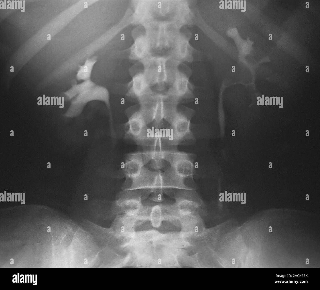 Kidney stones. Frontal intravenous urogram (IVU) X-ray of the abdominal ...