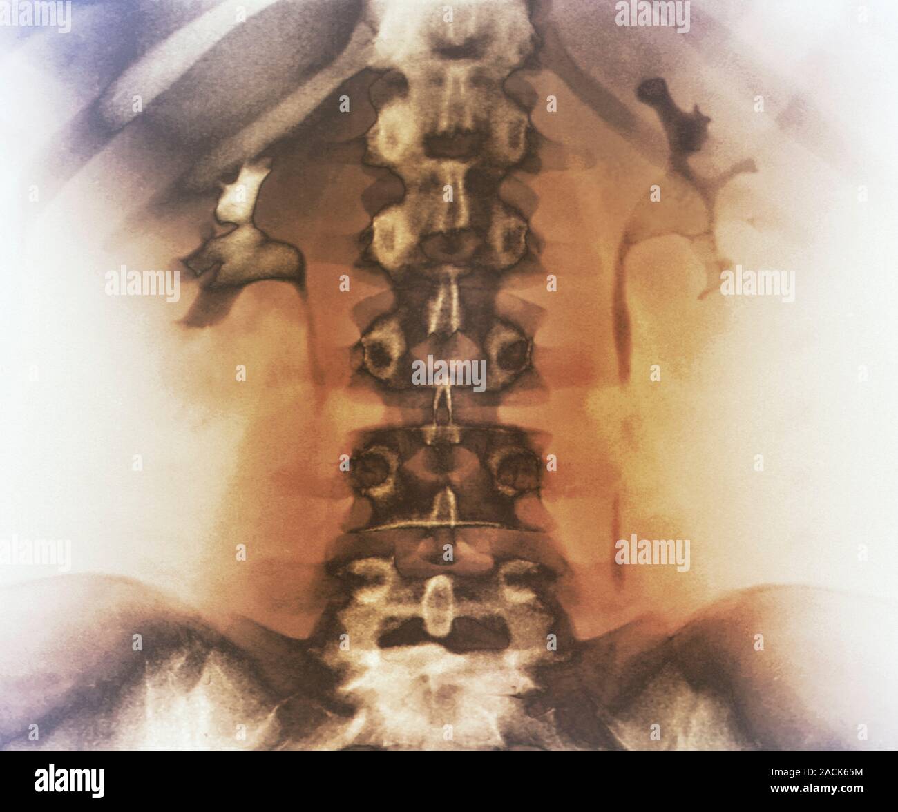 Kidney stones. Coloured frontal intravenous urogram (IVU) X-ray of the ...