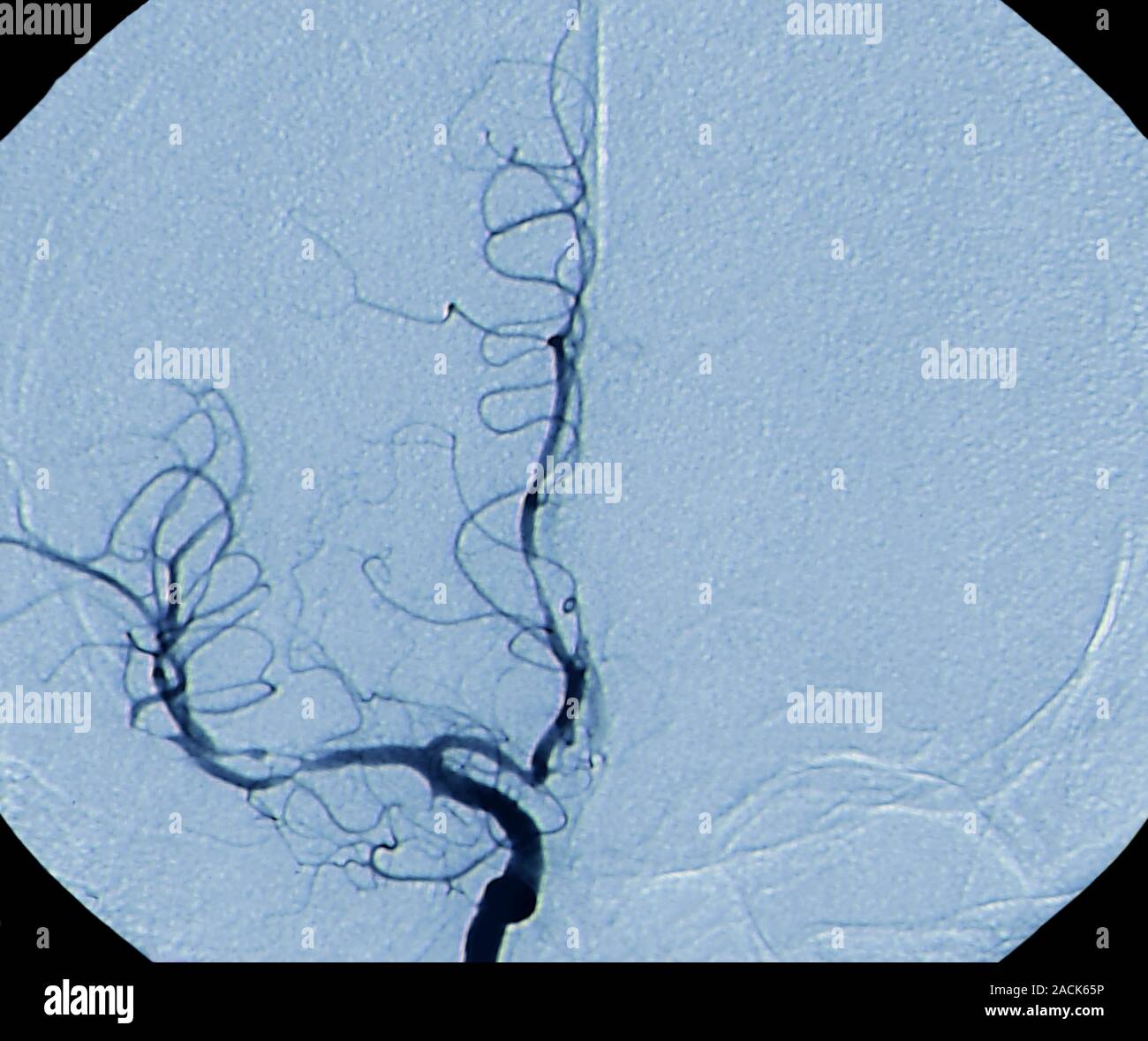 Cerebral vasculitis. Angiogram (blood vessel X-ray) of the brain of a ...