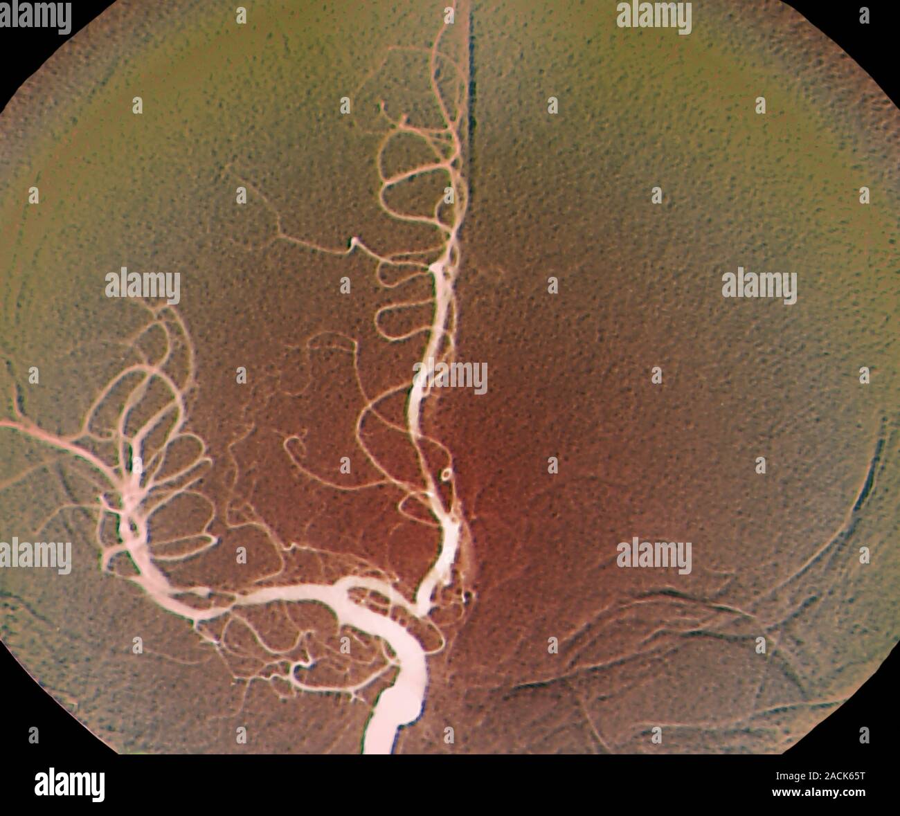 Cerebral vasculitis. Coloured angiogram (blood vessel X-ray) of the ...