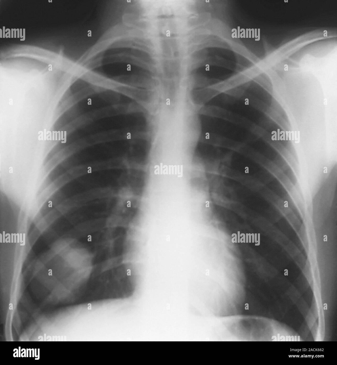 Pulmonary tapeworm cysts. Frontal chest X-ray showing hydatid cysts ...