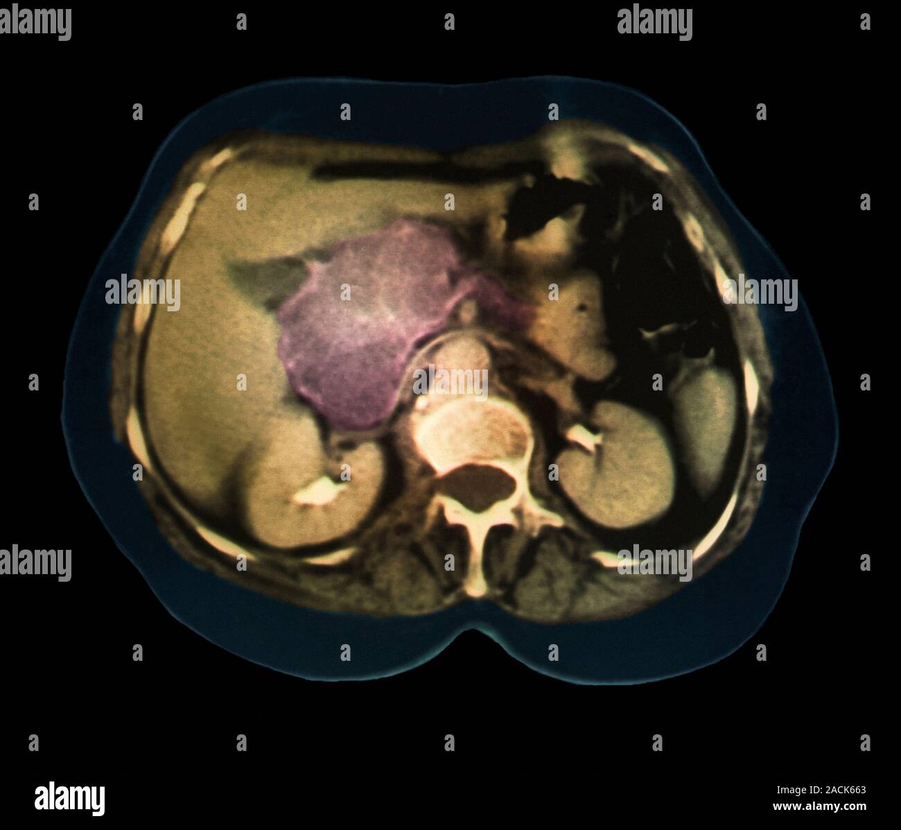 Cystic pancreas tumour. Coloured computed tomography (CT) scan in axial ... Cystic pancreas tumour. Coloured computed tomography (CT) scan in axial ...