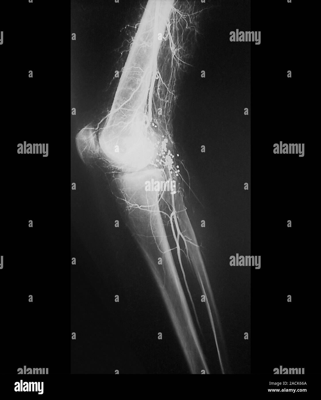 Arterial thrombosis removal. X-ray of the leg of a patient with a blood ...