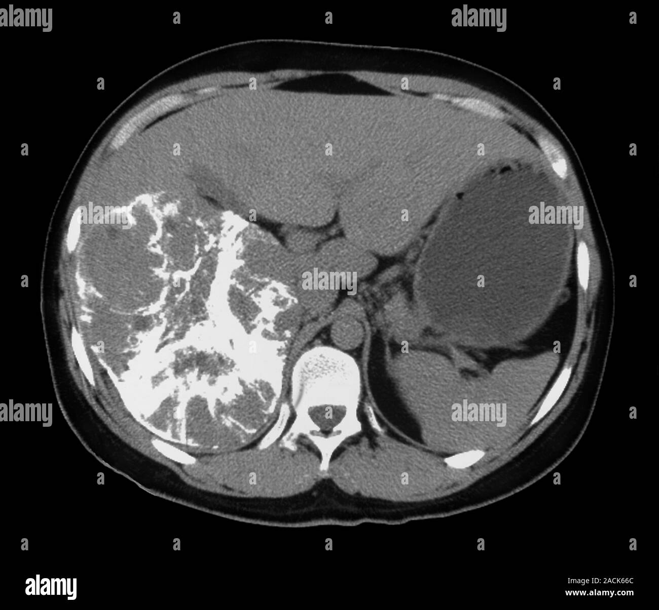 Liver cancer. Computed tomography (CT) scan in axial section of the ...