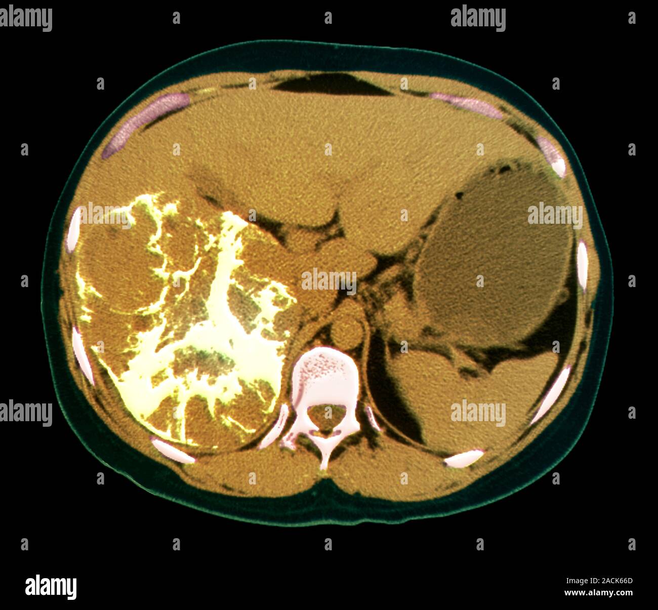 Liver cancer. Coloured computed tomography (CT) scan in axial section of the abdomen of a 15 ...