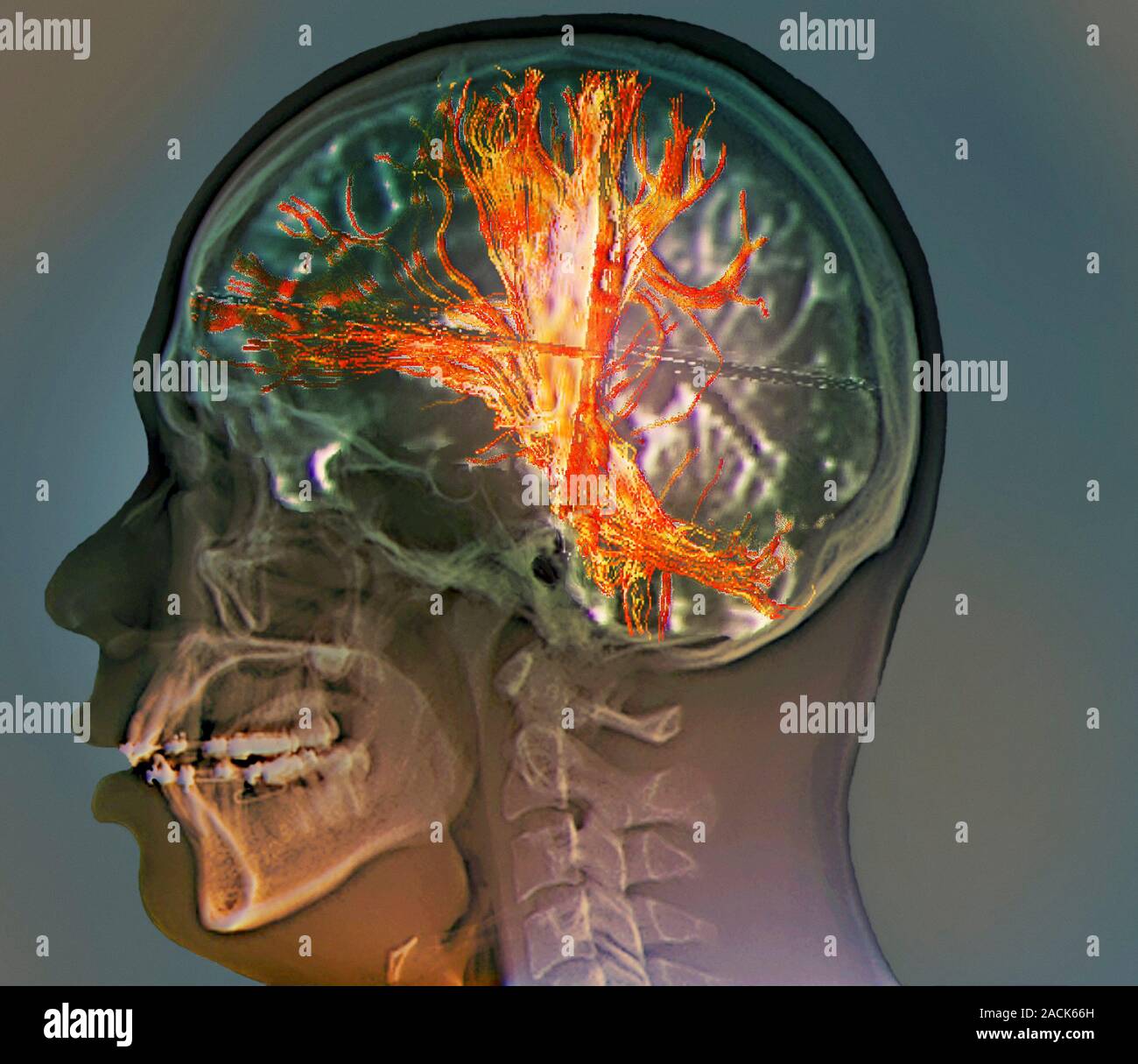Brain cancer. 3-D coloured tractography magnetic resonance imaging (MRI ...