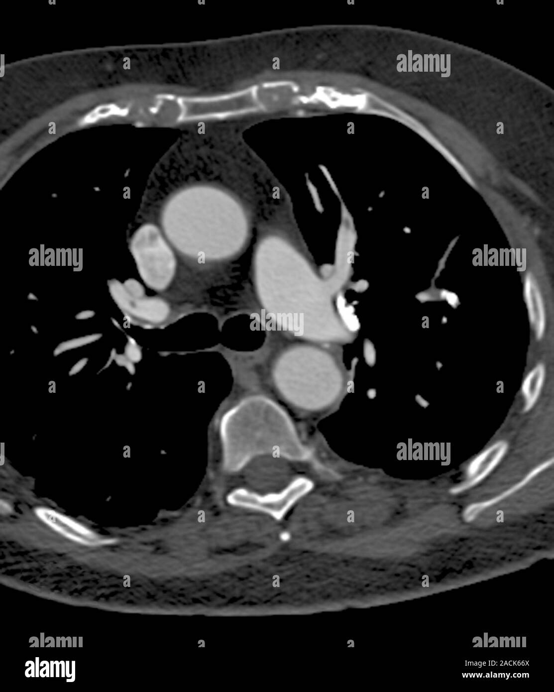 Pulmonary embolism. Computed tomography (CT) scan of an axial section ...