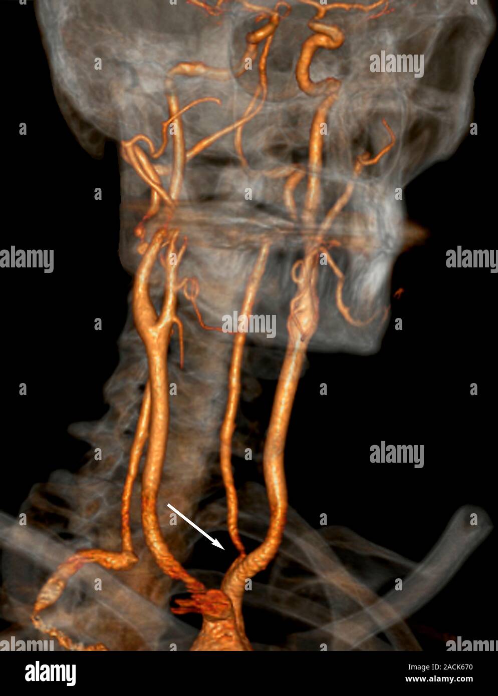 Stenosis of carotid artery. Coloured three-dimensional computed tomography (CT) angiography scan ...