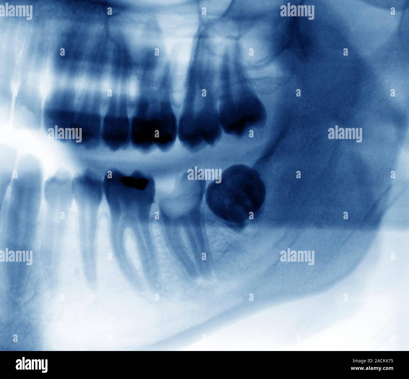 Tooth decay. Coloured X-ray of a profile view of a 22-year-old patient ...