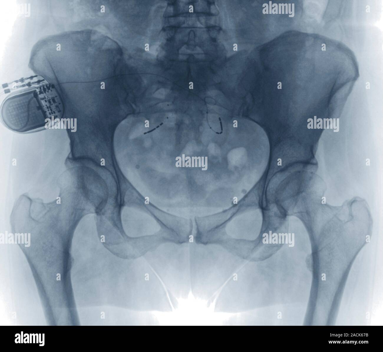 Incontinence implant. Frontal X-ray of the pelvic region of a 61-year ...