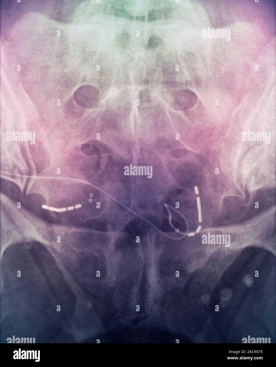 Incontinence implant. Coloured frontal X-ray of the pelvic region of a ...