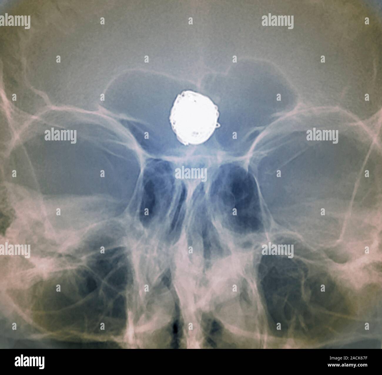 Treated intracranial berry aneurysm, coloured X-ray. Front view of the ...