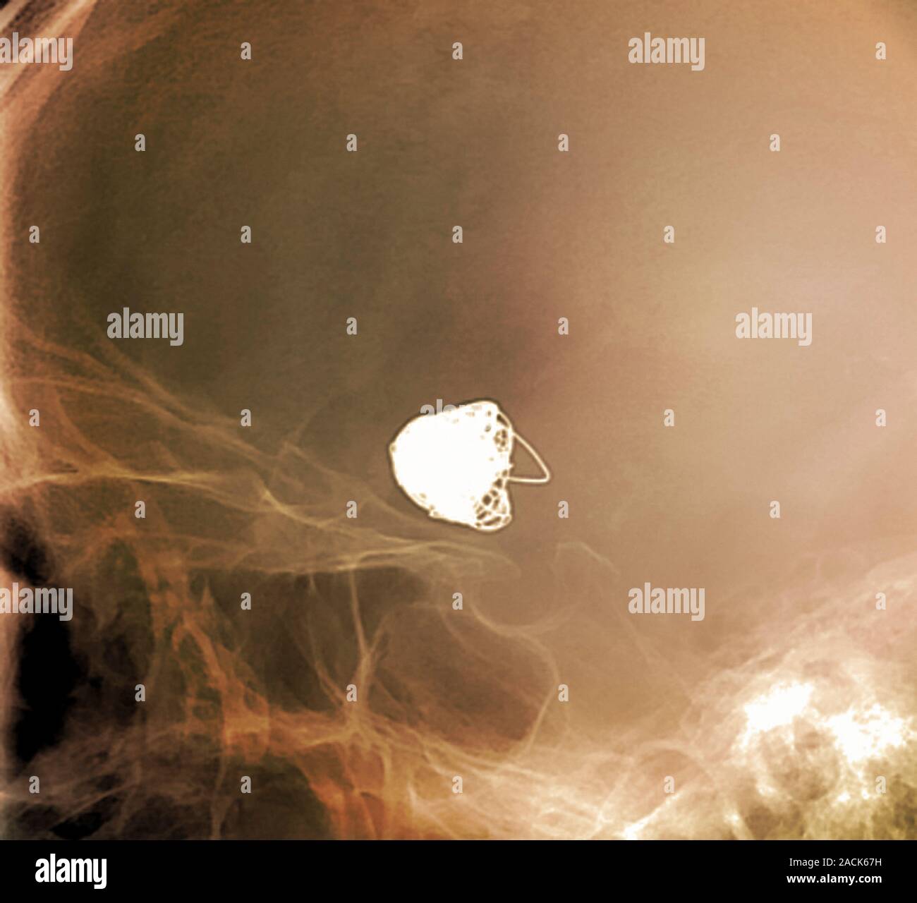Treated intracranial berry aneurysm, coloured X-ray. Side view of the ...