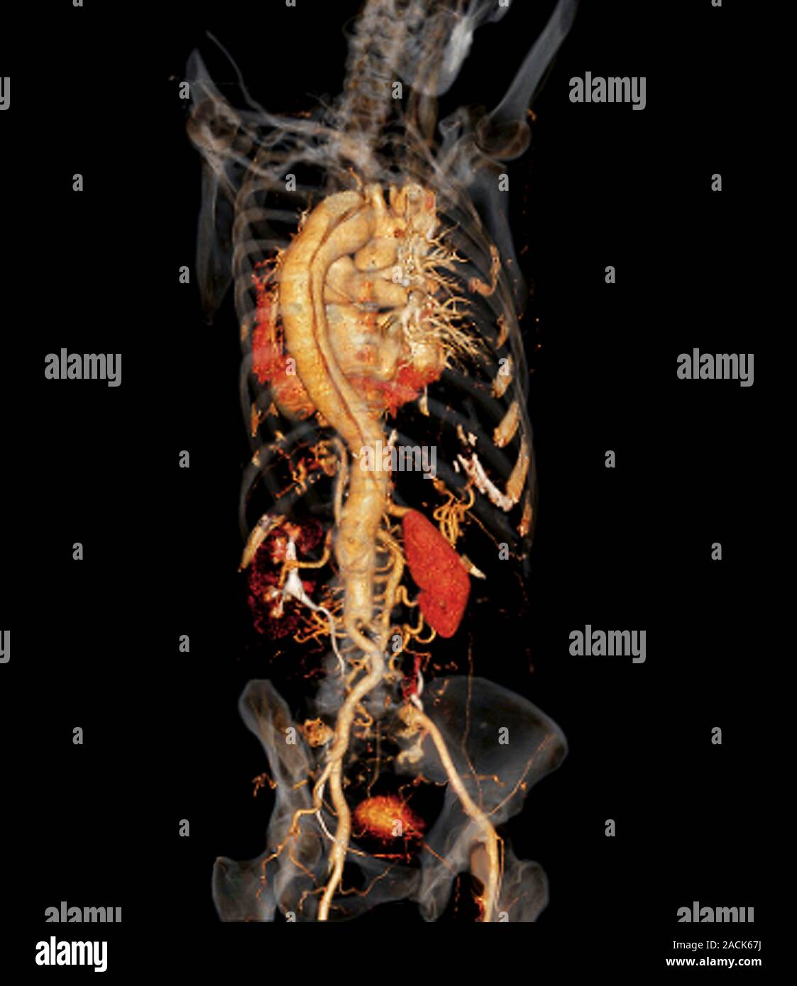 Aortic aneurysm, coloured 3D computed tomography (CT) scan. Front view of the abdomen of a 63 ...