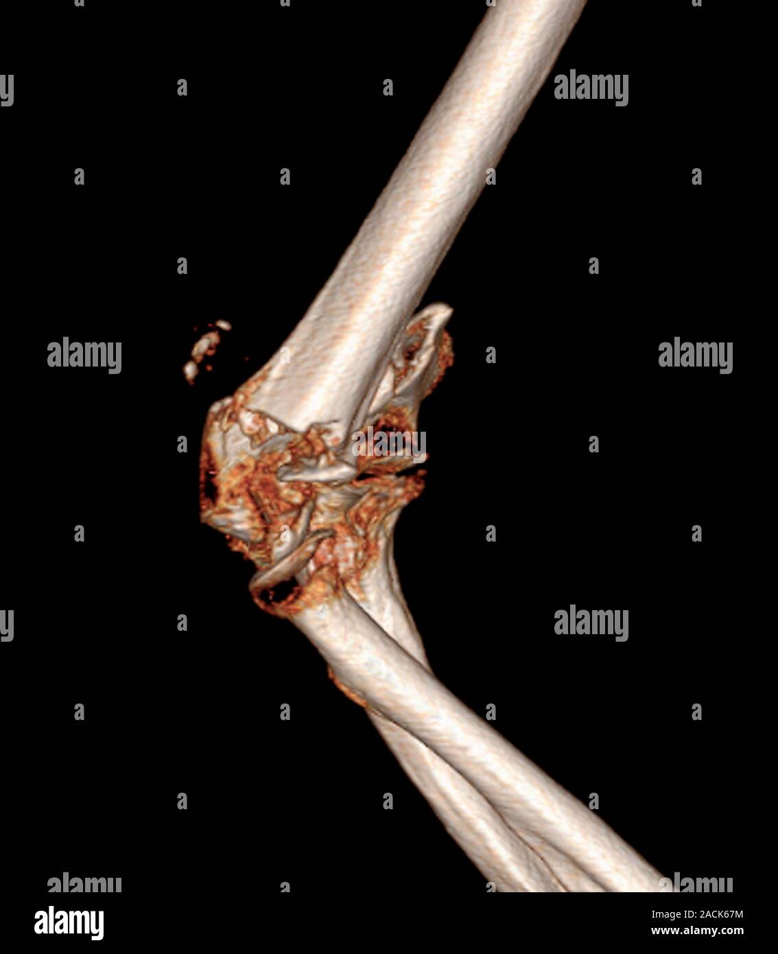 Fractured Elbow Coloured 3d Computed Tomography Ct Scan Of The Elbow