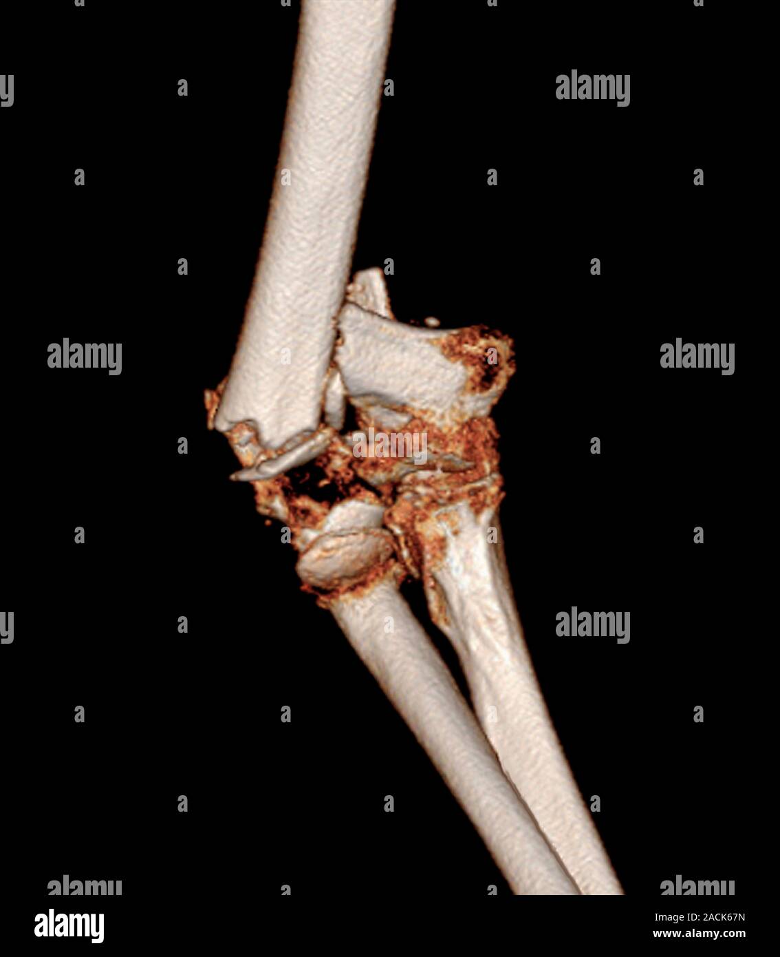 Fractured Elbow Coloured 3d Computed Tomography Ct Scan Of The Elbow