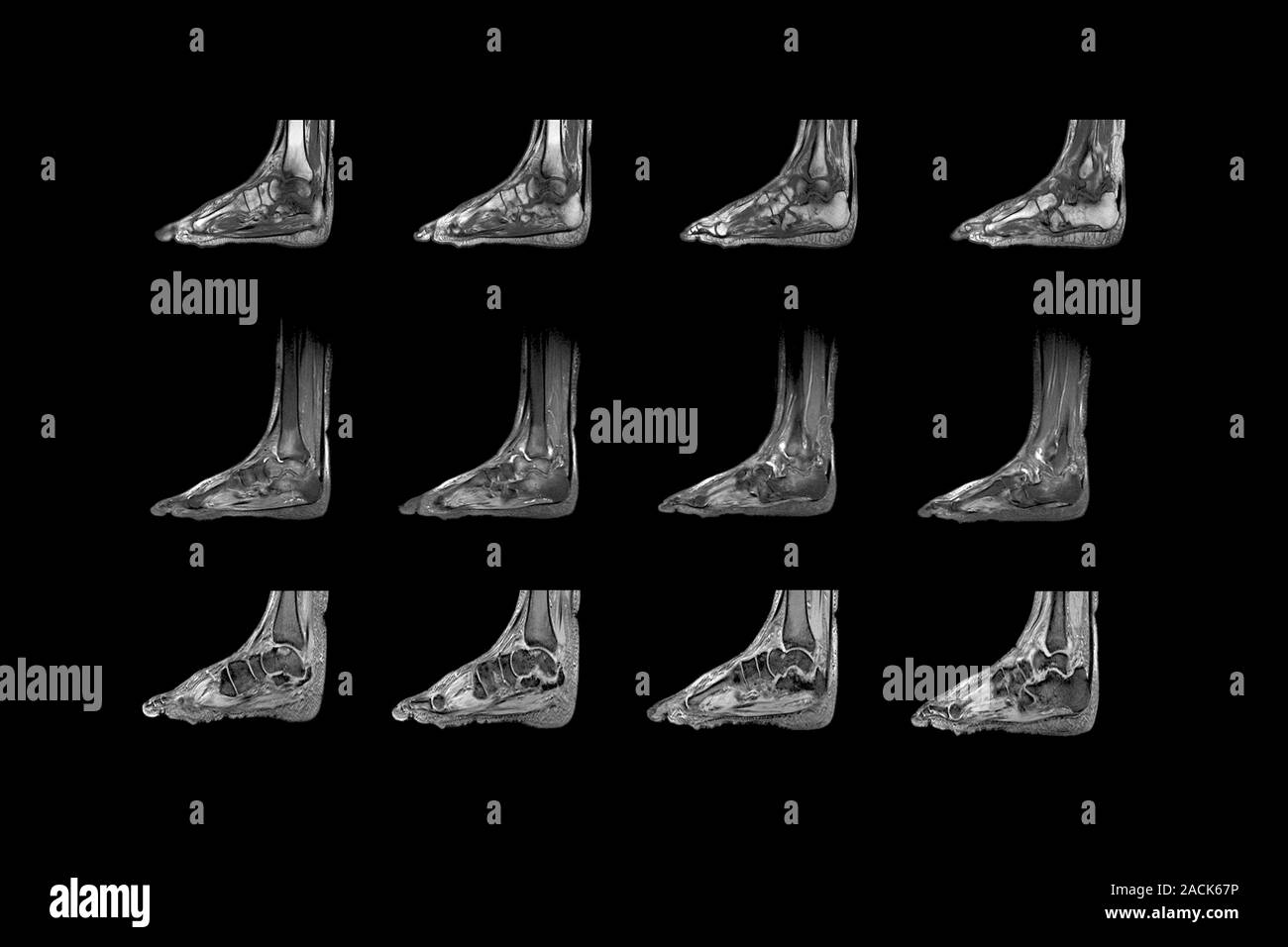 Charcot arthropathy. Magnetic resonance imaging (MRI) scans of the foot ...