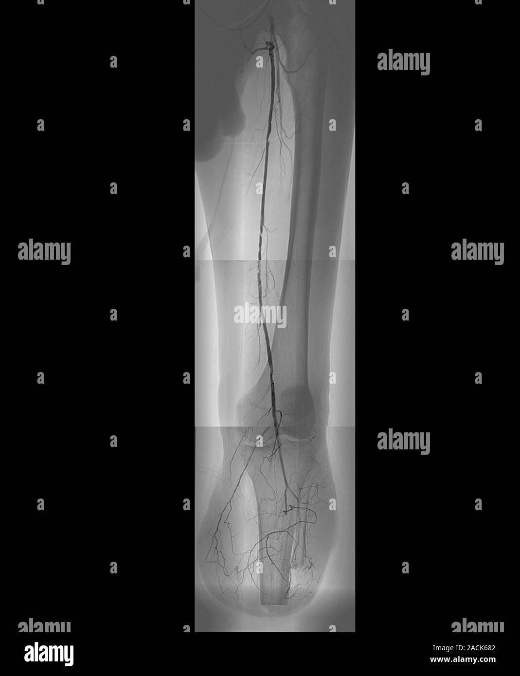 Diabetic amputee. Angiogram X-ray of the left leg of a 54-year-old ...