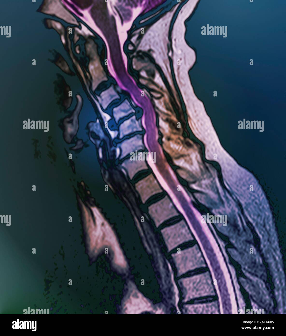 Slipped disc, coloured magnetic resonance imaging (MRI) scan. Profile ...