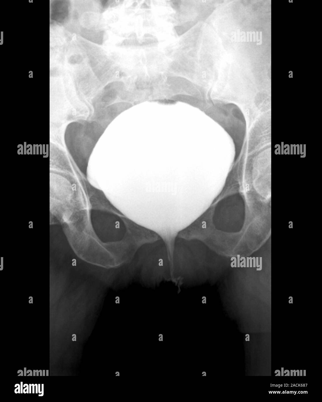 Full bladder. X-ray cystogram of the pelvic region of a 50-year-old ...